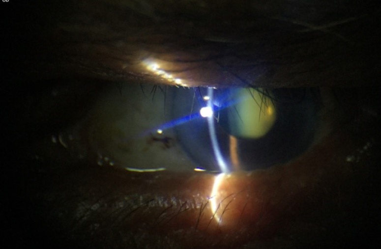 Remidio PSL D20 | Hand Held Portable Slit Lamp